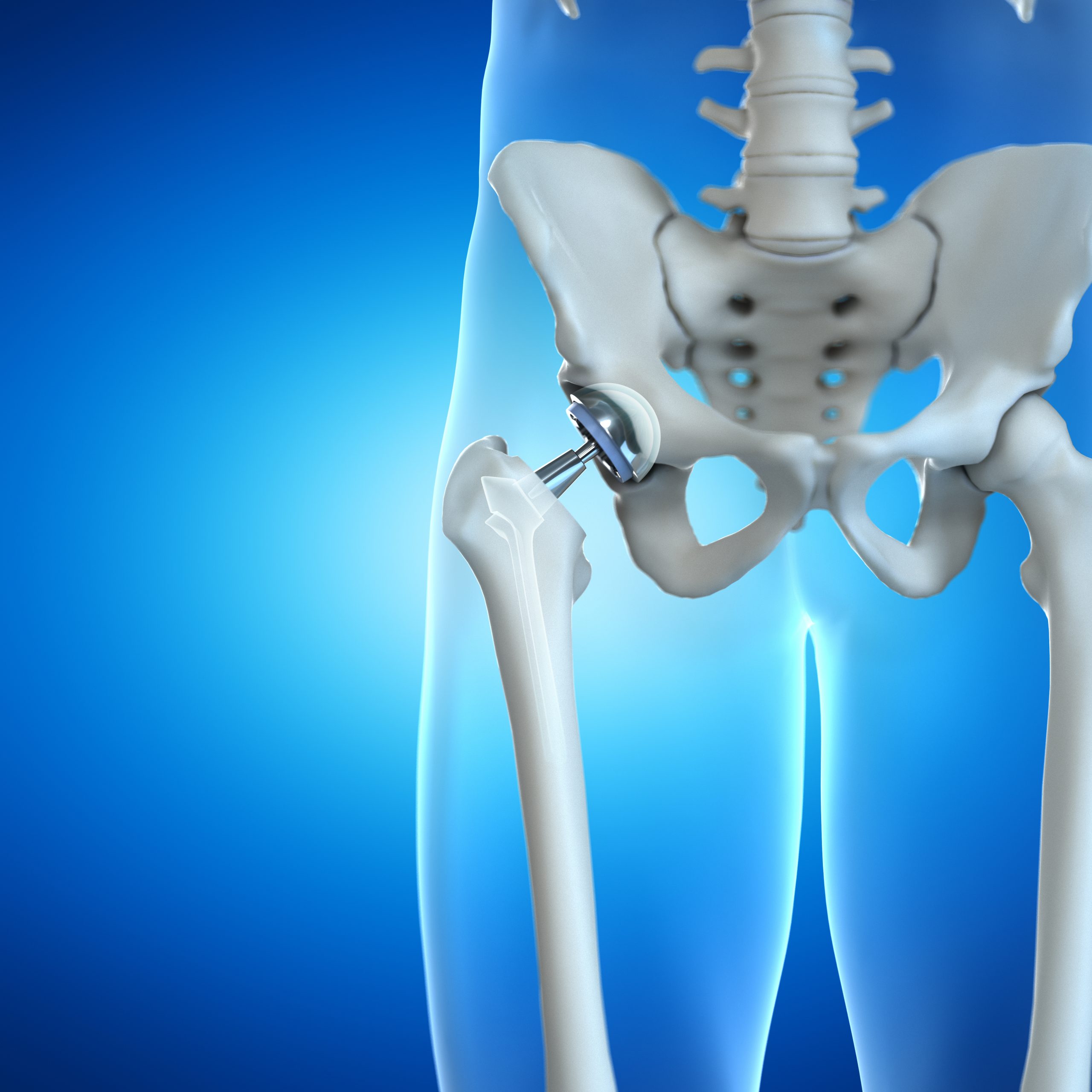 Hip Joint Replacement
